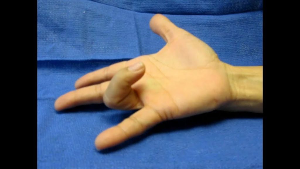 Trigger Finger Release Lamont J Cardon MD